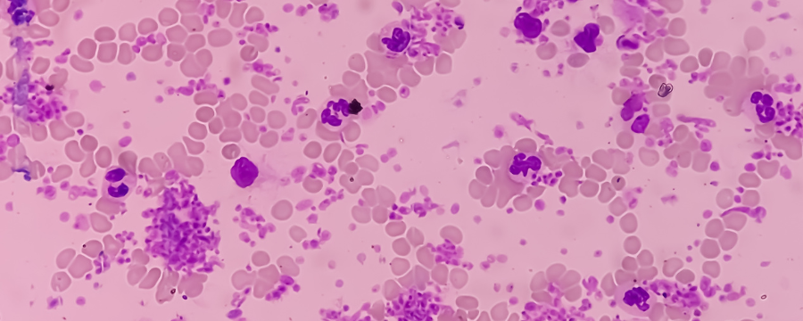¿Qué es Trombocitosis? - Causas y tratamiento